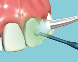 Micro-Stix™ Applicator with adhesive tip - Microbrush® International ...